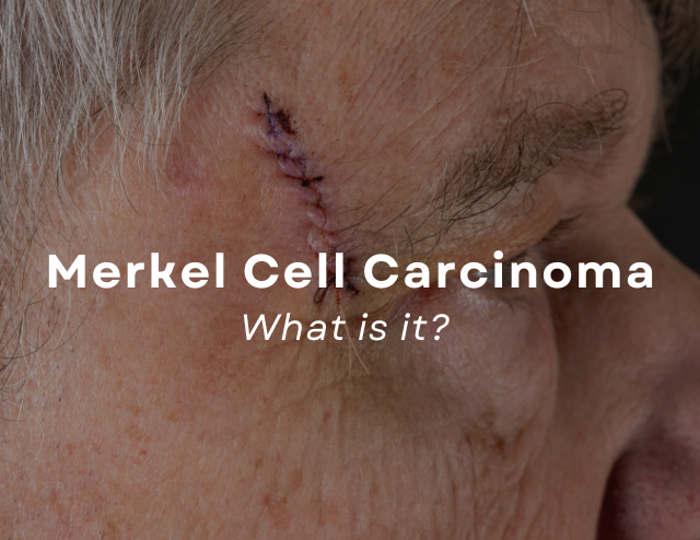What is Merkel Cell Carcinoma? - Cosmetic Surgery & Dermatology of Issaquah